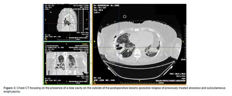 Journal Of Clinical Infectious Diseases And Practice Pyopneumothorax Caused By Streptococcus