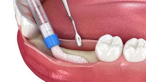 Advantages And Practicality Of Immediate Loading Dental Implants