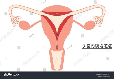 Diagrammatic Illustration Endometrial Hyperplasia Anatomy Uterus Stock
