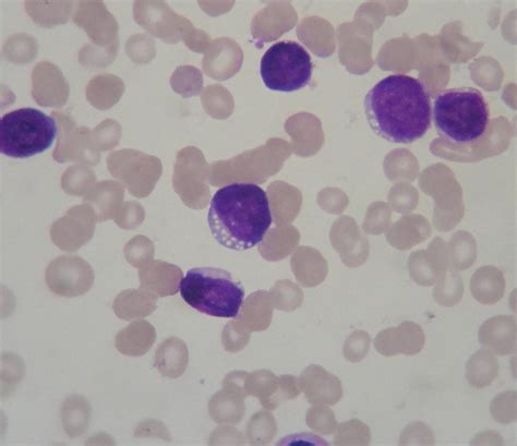 Lla L3 Linfocitos Con Citoplasma Básofilo Y Vacuolas Francisco Varas Cavieres Flickr
