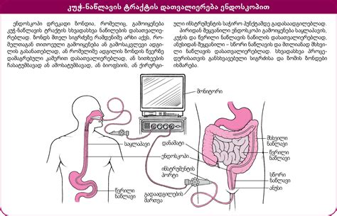 დიაგნოზი საჭმლის მომნელებელი სისტემის დაავადებების სიმპტომები და დიაგნოსტიკა მკურნალი გე
