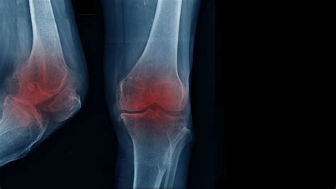 Torn Meniscus What It Is Causes Symptoms And Treatments