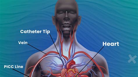 Central Venous Catheter Insertion