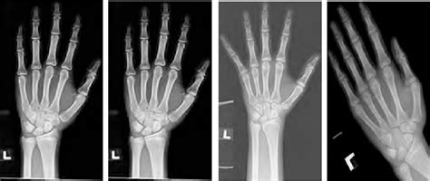 Figure 1 From Skeletal Maturity Recognition Using A Fully Automated System With Convolutional