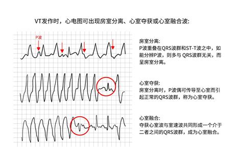 房室分离心电图特点 39健康网 精编内容