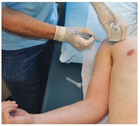 Subcoracoid Bursa Injection Wikism Sports Medicine Wiki