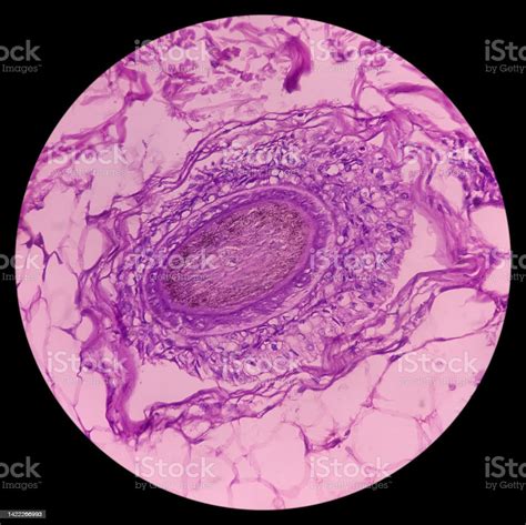 피부 생검 두피 암종 색소 침착 기저 세포 암종 태양의 가장 일반적인 유형은 피부암을 유도했다 손상에 대한 스톡 사진 및 기타 이미지 Istock