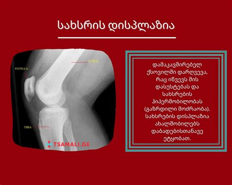 სახსრის დისპლაზია დაავადებები Tsamali Ge 🦵 სახსრის დისპლაზია