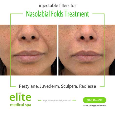 Nasolabial Fold Removal A Pretreatment Views Of Left And Right