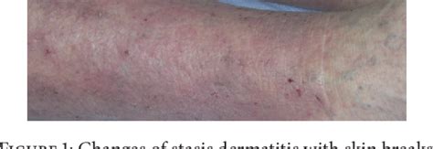 Figure 1 From Pasteurella Multocida Bacteremia In An Immunocompromised