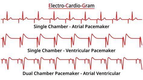 Temporary Epicardial Pacing Nursing Ce Central