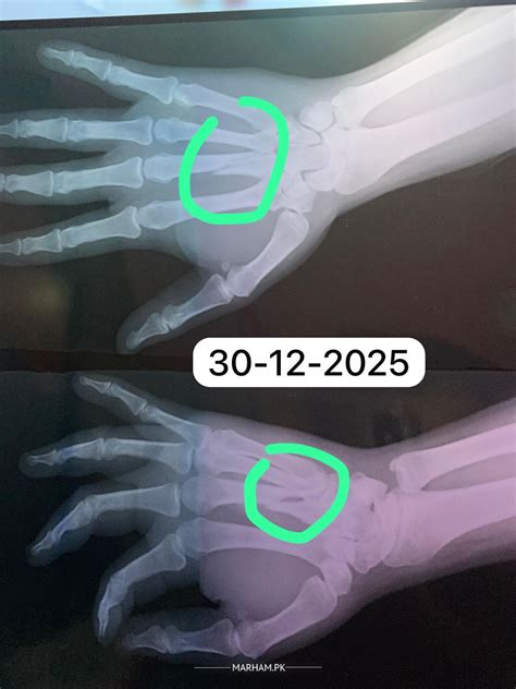 Ask A Orthopedic Surgeon Online For Bone Fractured Metacarpal Not Healing