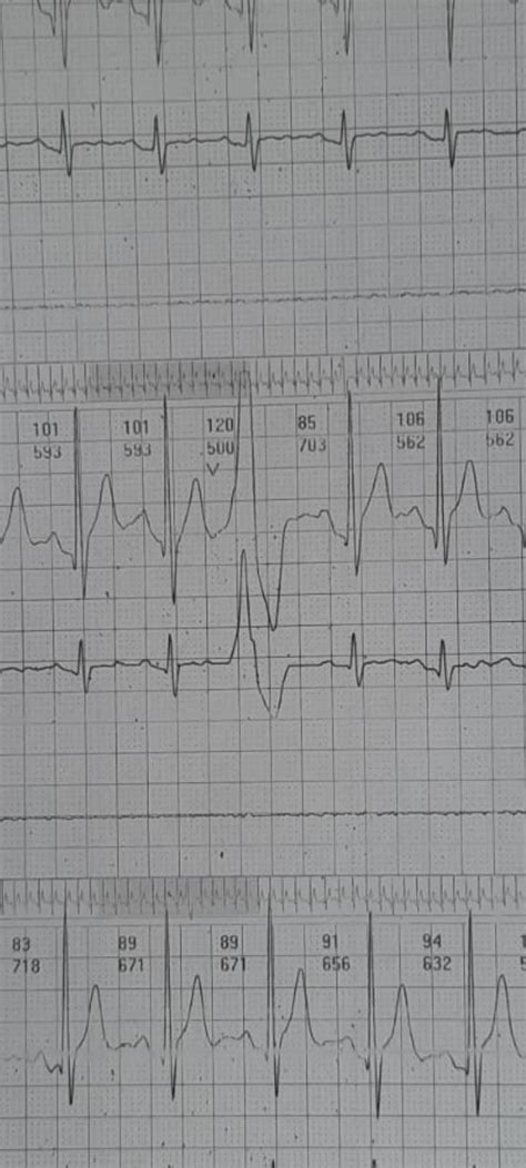 Pvc Pattern With Lbbb Morphology Or Rbbb Morphology R Askcardiology
