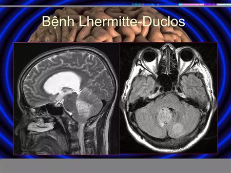 Congenital Brain Malformation Ppt