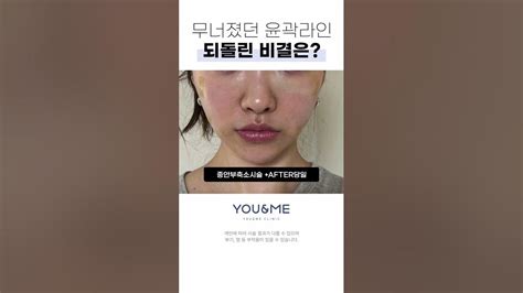 강력하고 오래 지속되는 리프팅 시술을 찾는다면 중안부축소리프팅실리프팅후기 Youtube