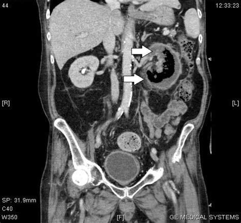 Emphysematous Pyelonephritis