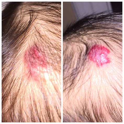 Cherry Angioma Vs Strawberry Hemangioma At Elbert Lucas Blog