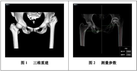 漯河市骨科医院完成定制个体化3D打印髋臼假体植入手术 中国3D打印网