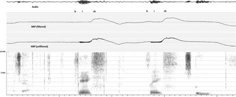 Audio Top Nasal Ram Pressure Middle And Spectrogram Bottom