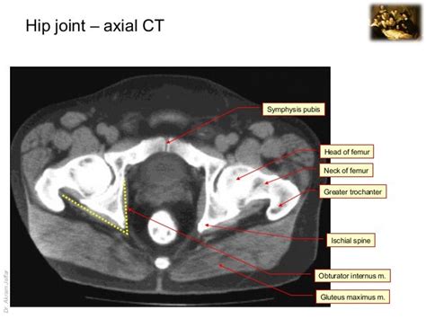 Imaging Anatomy Dislocation Of The Hip Joint