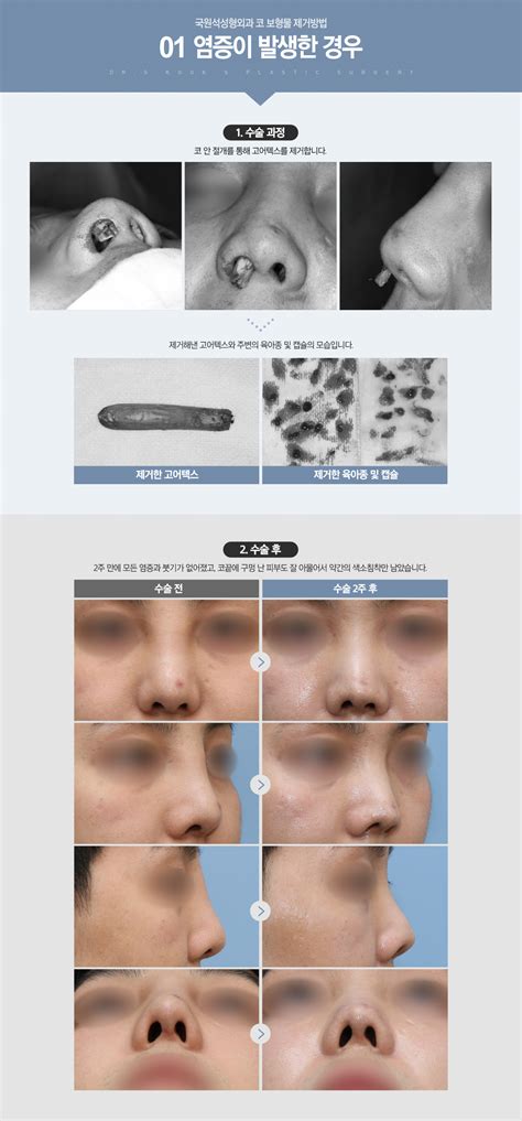 국원석 성형외과 코 보형물 제거