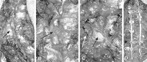 One Stage Posterior Hemivertebra Resection And Correction Us Spine