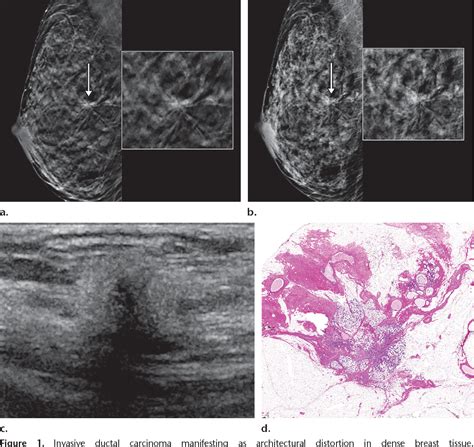 Figure 1 From Tomosynthesis Detected Architectural Distortion Management Algorithm With