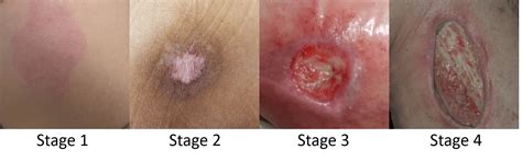 Skin Pressure Ulcer Stages