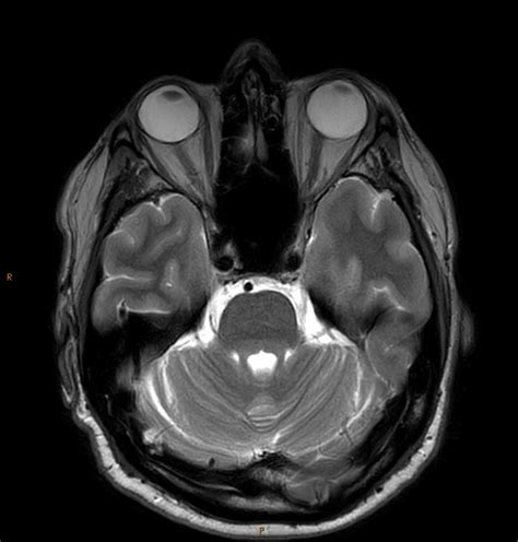 File Diffuse Astrocytoma Idh Mutant Radiopaedia 98918 120113 Axial 15