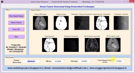 Brain Tumor Detection Using Watershed Segmentation Matlab Project With