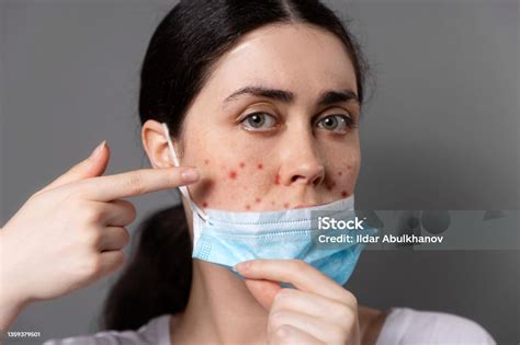 Maskne Portrait Of A Young Caucasian Woman Shows Pimples On Her Cheeks