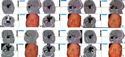 Imagine Guidance From Neuronavigation System Showing Measurements Of Download Scientific
