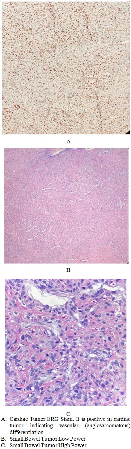 Figure 5 Resected Cardiac Mass Pathology A Rare Case Of High Grade Metastatic Intimal Sarcoma