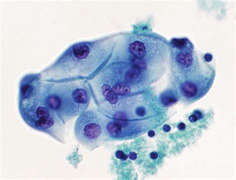 29 Papillary Thyroid Carcinoma Diffuse Sclerosing Variant The Download Scientific Diagram