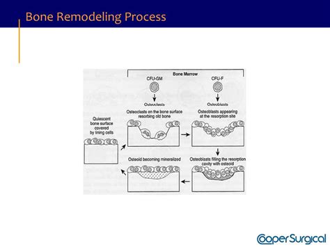 Ppt Osteoporosis Powerpoint Presentation Free Download Id416333