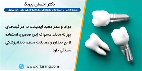 هر آنچه باید در مورد ایمپلنت فرانسوی بدانید دکتر احسان بیرنگ