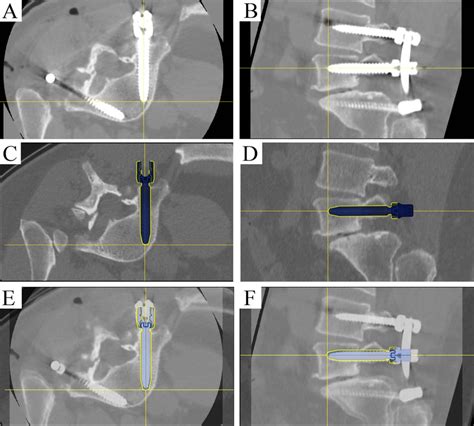 screw tip tail and angle offset assessment postoperative ct of l5