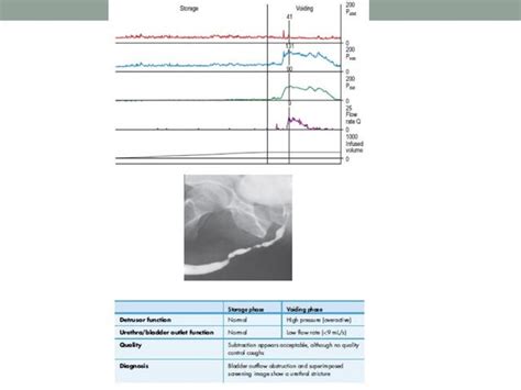 Urology Neurogenic Bladder Urodynamicspptx