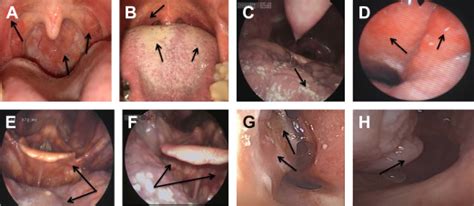 Future Directions In Managing And Treating Laryngopharyngeal Reflux