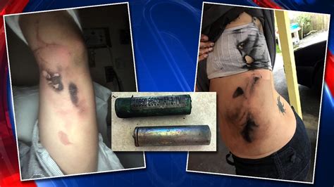 Woman Claims Second Degree Burns From Exploding Vape Batteries Fox 4 Dallas Fort Worth Woman Claims Second Degree Burns From Exploding Vape Batteries Fox 4 Dallas Fort Worth