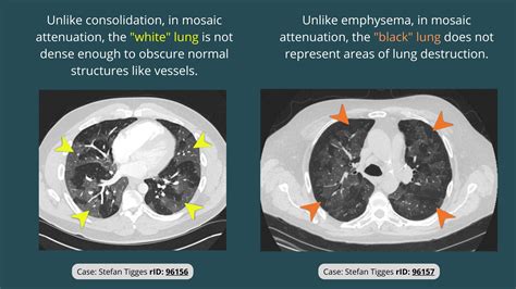 🎯 Do You Understand Mosaic Attenuation Facebook