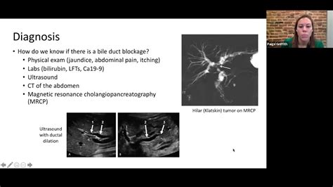 Webinar Biliary Stent And Drain Management For Patients With Cholangiocarcinoma Youtube