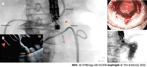 Endoscopic Ultrasound Guided Gastrojejunostomy A And B The Small Download Scientific Diagram