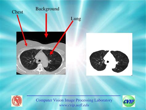 Ppt Detection Visualization And Identification Of Lung Abnormalities In Chest Spiral Ct