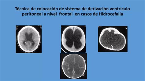 Técnica De Colocación Del Sistema De Derivación Ventrículo Peritoneal A