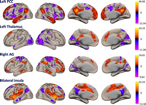 Functional Connectivity Networks Associated With The Posterior