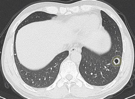 A 25 Year Old Male With Aids Complicated By Cryptococcus Pneumonia Download Scientific Diagram