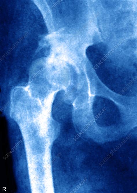 Dislocated Hip X Ray Stock Image C062 1212 Science Photo Library