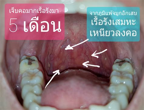 โรคภูมิแพ้จมูก กับ อาการกลิ่นปากและลมหายใจเหม็น 1 ส่วนใหญ่จะผ่านการตรวจโดยหมอฟันมาแล้วไม่เจอ