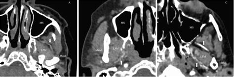 Route Of The Maxillary Artery In The Infratemporal Fossa A Only Download Scientific Diagram